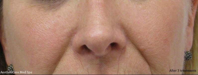 Before & After IPL Patient 01 Photos | Orange County & Riverside ...