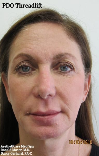 Before & After PDO Thread Patient 01 Photos | Orange County & Riverside ...