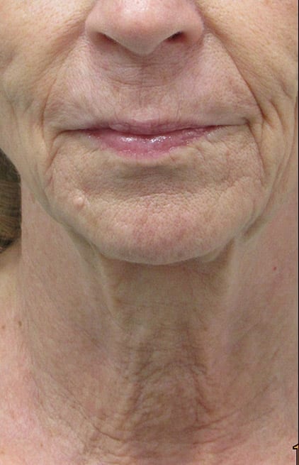 Before & After PDO Thread Patient 02 Photos | Orange County & Riverside ...